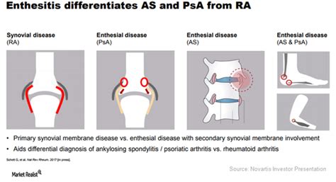 How Cosentyx Resolves Enthesitis In Psoriatic Arthritis Patients