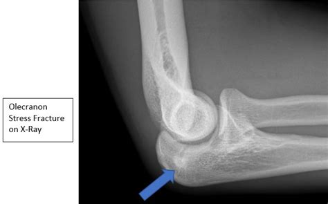 Olecranon Stress Fracture Oklahoma County Elbow Fractures Oklahoma County