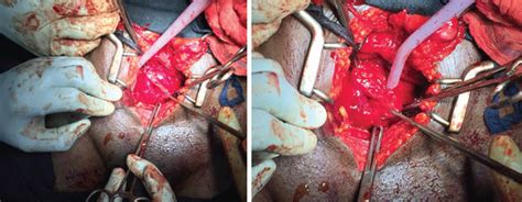 Open Surgical Repair Of Multiple Bladder Diverticula Download