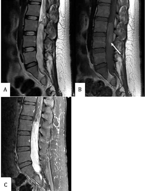 Cauda Equina Thickening An Approach To Mri Findings Clinical Radiology