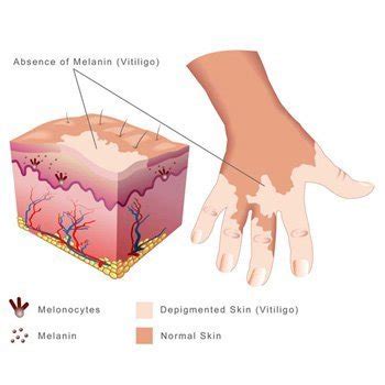 Vitiligo Signs And Symptoms Causes And Initial Signs Of Vitiligo