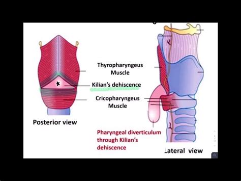 True Vs False Diverticulum