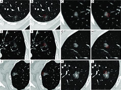 Examples Of Sd Values In Benign Ssns Aah Ais Mia And Ia A A 15