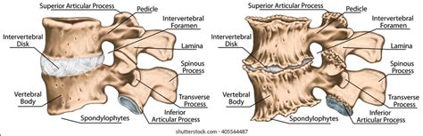 Uncovertebral Joint Hypertrophy Epos™