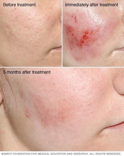 Dermabrasion Mayo Clinic