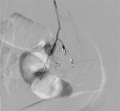 Selective Angiography After Embolization Download Scientific Diagram