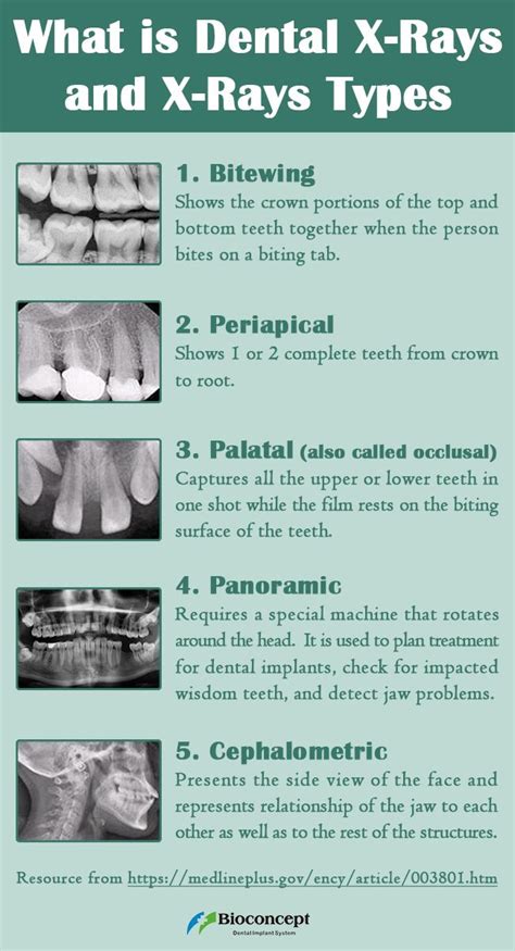 What Is Dental X Ray X Rays Radiographs Krkrb