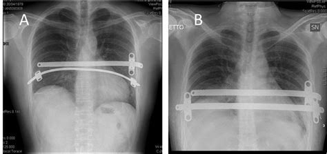 Patient With A Dislocation Of A Bar A And With The Bar In The Correct