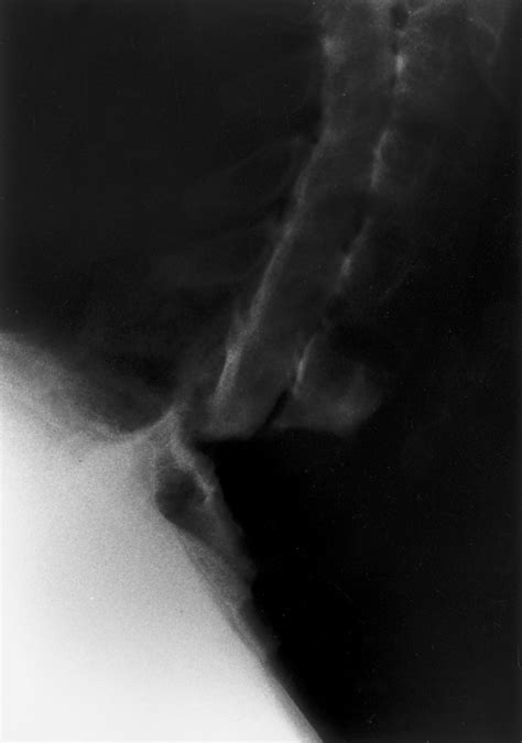 Lessons Learned From Cervical Pseudoarthrosis In Ankylosing Spondylitis Pmc