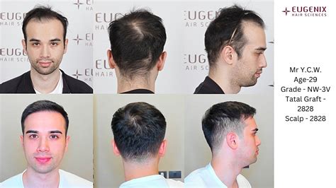 Norwood Scale 3v Baldness Hair Transplant And Treatment Uk