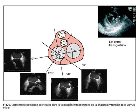 Ecocardiografía En La Valvulopatía Mitral