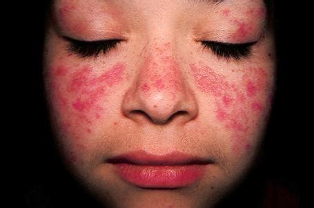 Discoid Lupus Erythematosus Pictures Treatment Symptoms