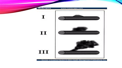 Coronary Artery Perforation Pptx