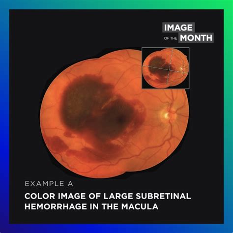 Subretinal Hemorrhage Oct