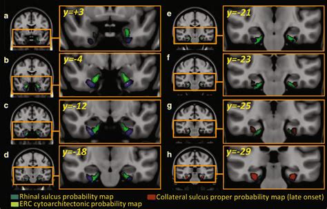Illustration Of The Probability Maps Of The Rhinal Sulcus In Blue And