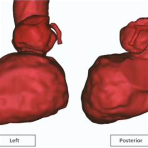 Multiplane Views Of Left Ventricular Pseudoaneurysm Download Scientific Diagram