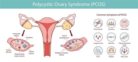 Premium Vector Polycystic Ovary Syndrome Pcos Ovarian Cysts Of The