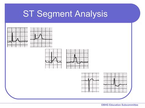 Chapter 6 Introduction To 12 Lead Interpretation Ppt