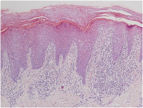 Polymorphous Light Eruption Histology