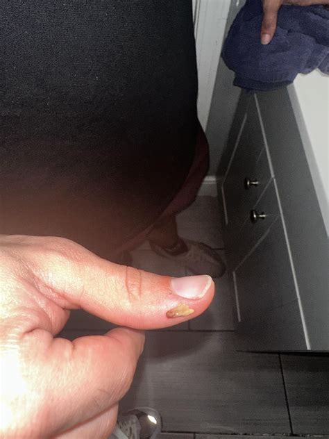 Gross Pic Attached All 4 Removed Friday July 7th Helpparanoid R