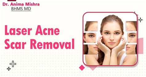 Laser Acne Scar Removal Anima Mishra