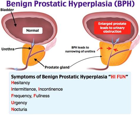 Rosh Review Benign Prostatic Hyperplasia Nursing School Survival