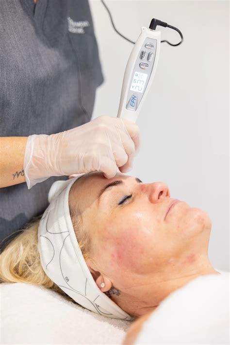 Micro Skin Needling The Treatment Centre