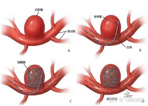 【科普】什么是颅内动脉瘤 知乎