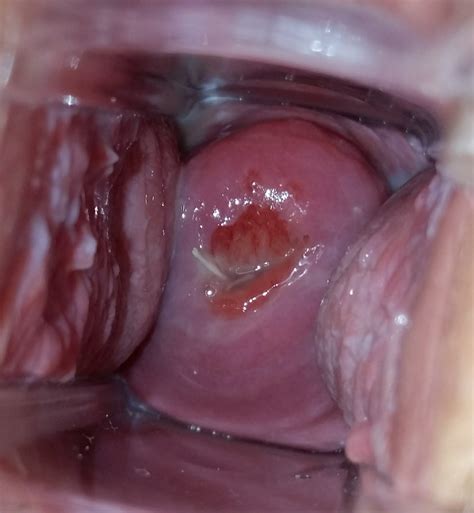 Age 25 Iud And Ectropion Most Of Cycle Beautiful Cervix Project