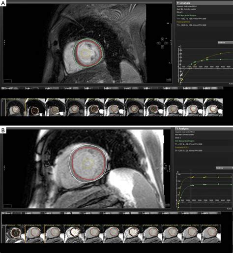 Myocardial T1 Mapping Modalities And Clinical Applications Pmc