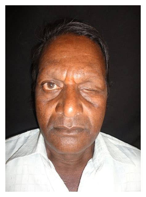 Patient With Left Side Ocular Defect Download Scientific Diagram