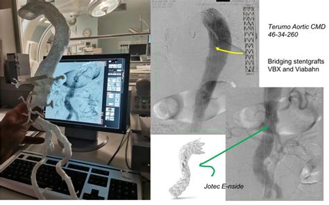 Emiliano Chisci On Linkedin Today A Very Complex Type Ii Taaa With The