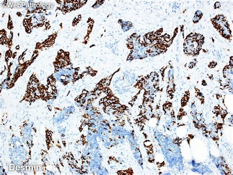 Desmoplastic Small Round Cell Tumor Desmin