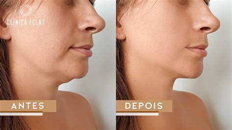 Protocolo Papada Negativa Clínica Eclat Dermatologia Tricologia Implante Capilar