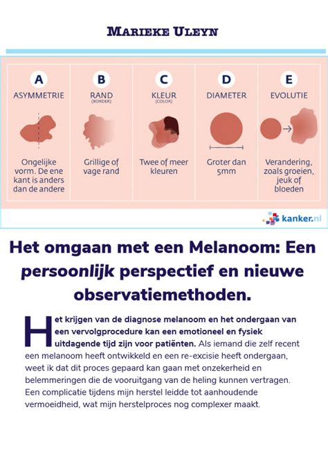 23 010 Melanoom Marieke Uleyn Voetzorgplus
