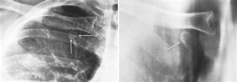 The Soft Tissues Of The Thorax Clinical Tree