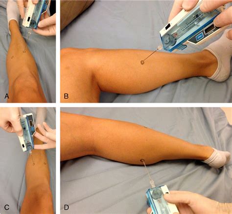 Figure 2 From Chronic Exertional Compartment Syndrome Testing