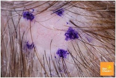 Skin Cancer On Scalp