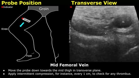 Femoral Vein Doppler Ultrasound Probe Positioning Lower Limb Veins