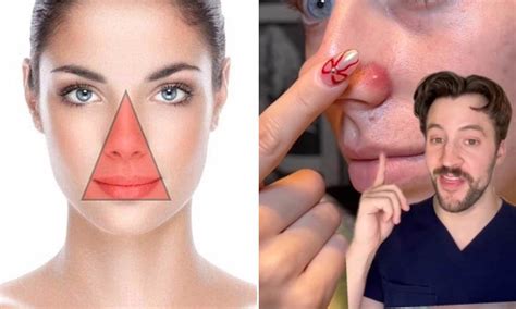 Why You Should Never Pop A Pimple Thats In The Triangle Of Death