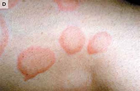 Urticaria And Angioedema Amboss Rotation Prep