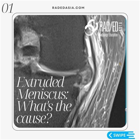 Knee Mri Meniscus Root Tear Extrusion Radiology Education Asia