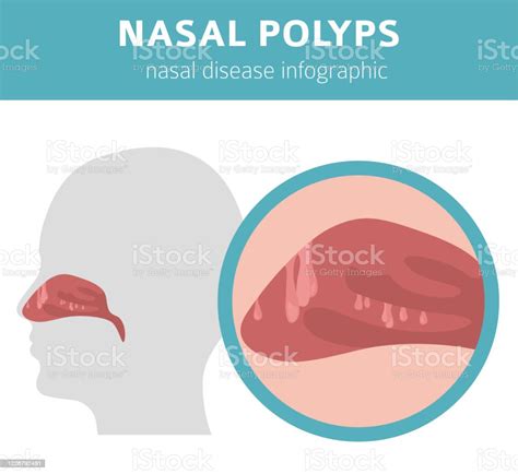 Nasal Diseases Nasal Polyps Causes Diagnosis And Treatment Medical