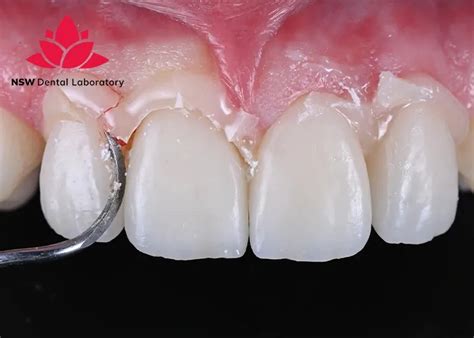 Crown Cementation Clinical Guidelines Tips And Best Practices For Success Nsw Dental Lab