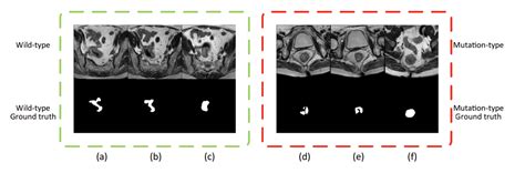 A Segmentation Based Sequence Residual Attention Model For Kras Gene Mutation Status Prediction