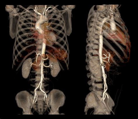 Ct Abdominal Aorta Ct Aortogram