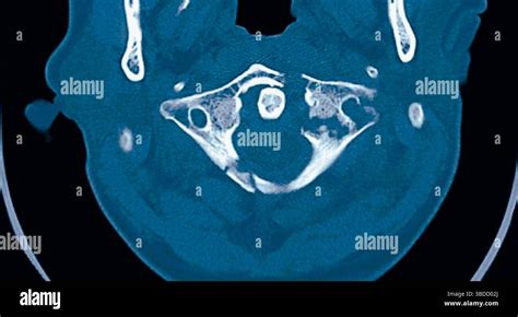 Coloured Computed Tomography Ct Scan Of A Jefferson Fracture A Fracture Of Both The Anterior
