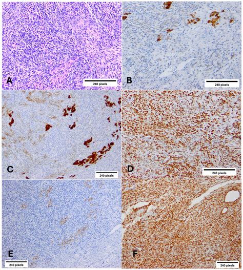 A Novel Pathogenic Variant Of Dicer1 Gene In A Young Greek Patient With