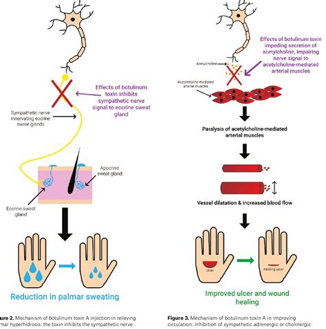 Figure 3 From Role Of Botulinum Toxin In The Management Of Hand
