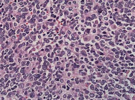Différence entre le phéochromocytome et le neuroblastome Diffexpert